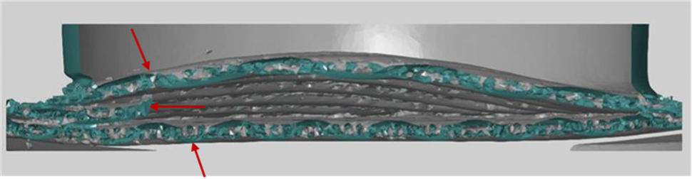 SYFOVRE: Insights on Case Reports of Retinal Vasculitis and Removal of ...