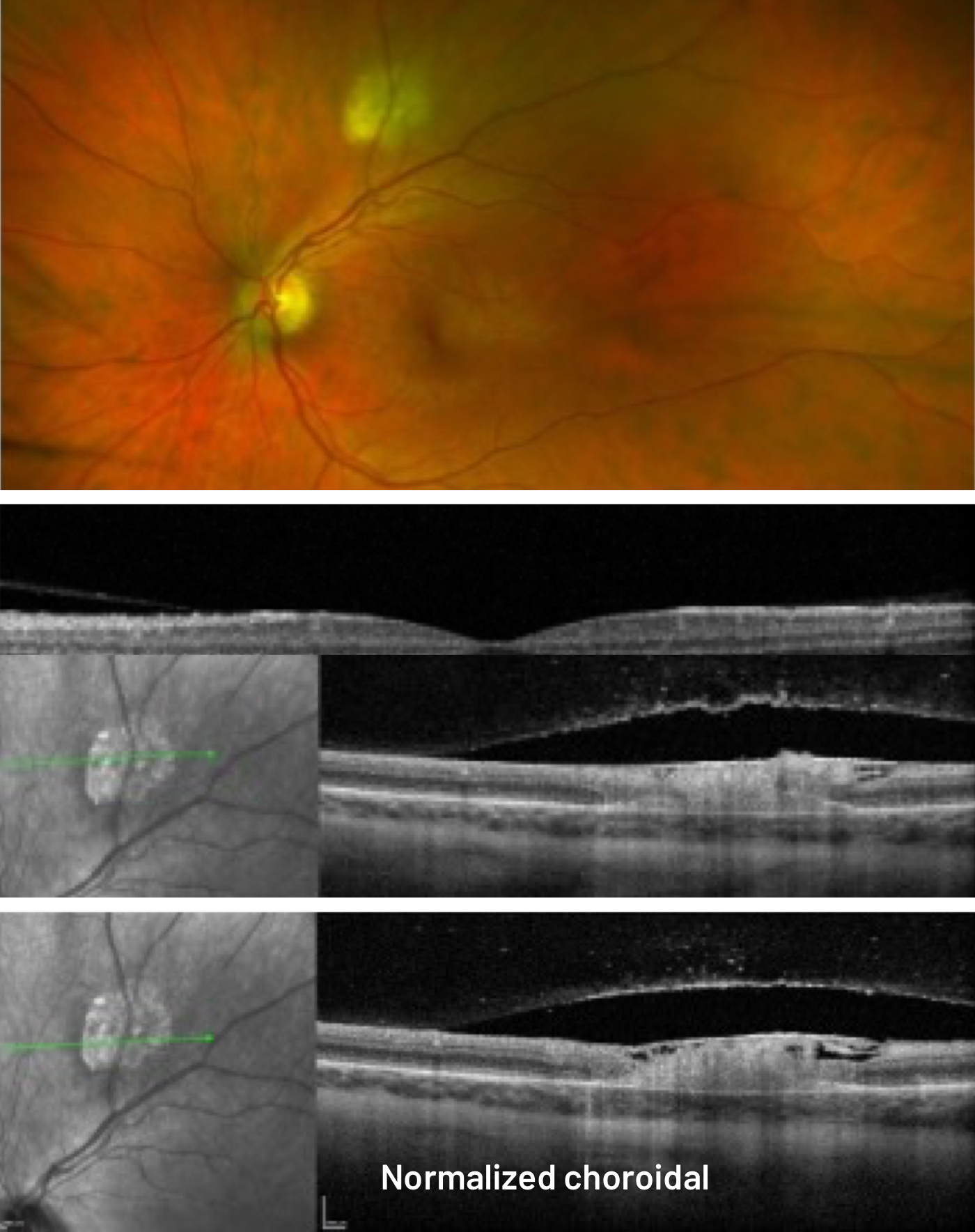 Collaborative Case #005: Things that Bug the Retina - Modern Optometry