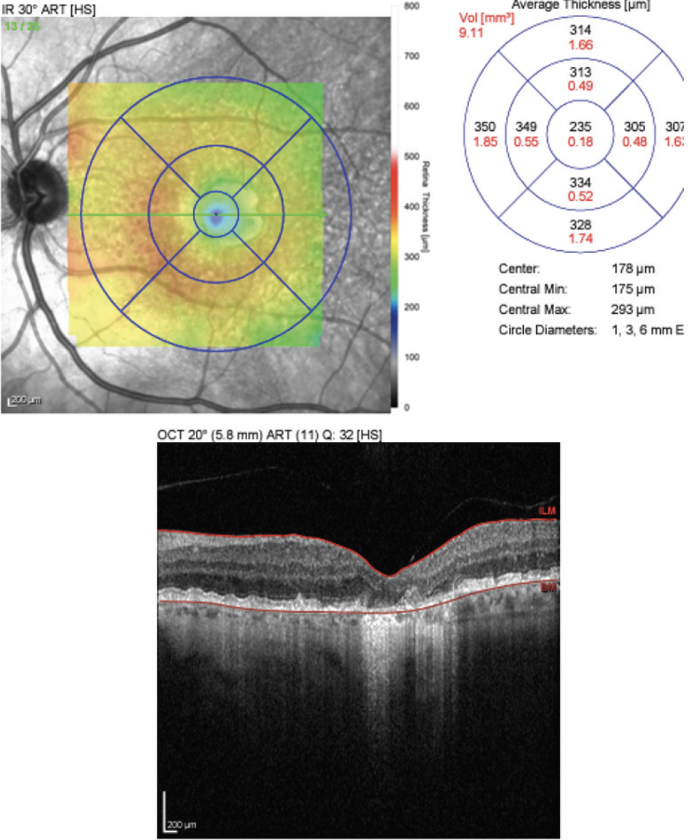 Geographic Atrophy: Options in Clinical Therapy - Retina Today