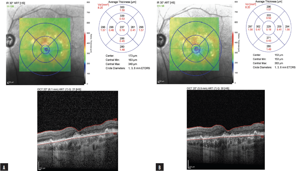 Geographic Atrophy: Options in Clinical Therapy - Retina Today
