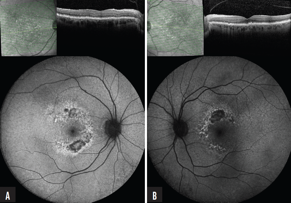 Geographic Atrophy: Options in Clinical Therapy - Retina Today