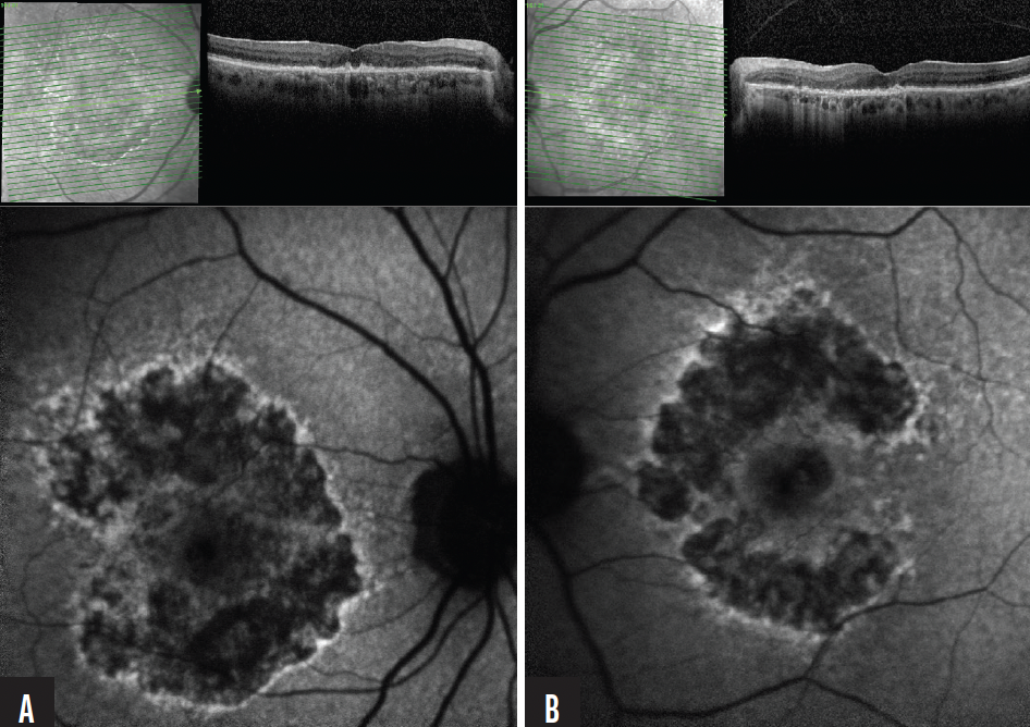 Geographic Atrophy: Options in Clinical Therapy - Retina Today