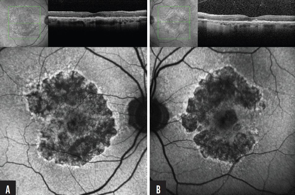 Geographic Atrophy: Options in Clinical Therapy - Retina Today