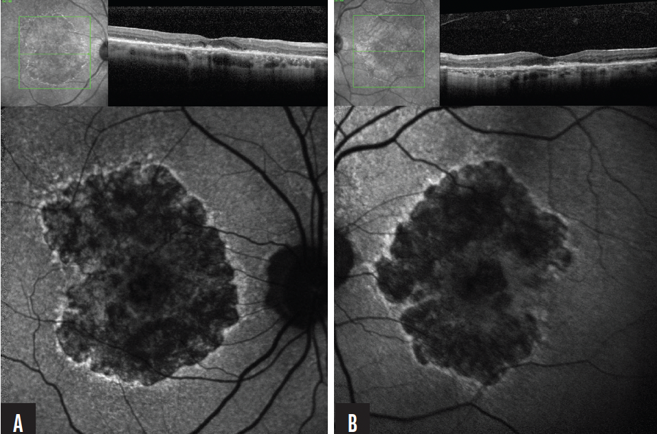 Geographic Atrophy: Options in Clinical Therapy - Retina Today