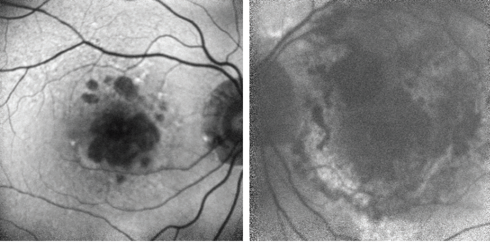Geographic Atrophy: Options in Clinical Therapy - Retina Today
