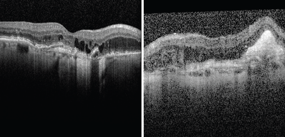 Geographic Atrophy: Options in Clinical Therapy - Retina Today