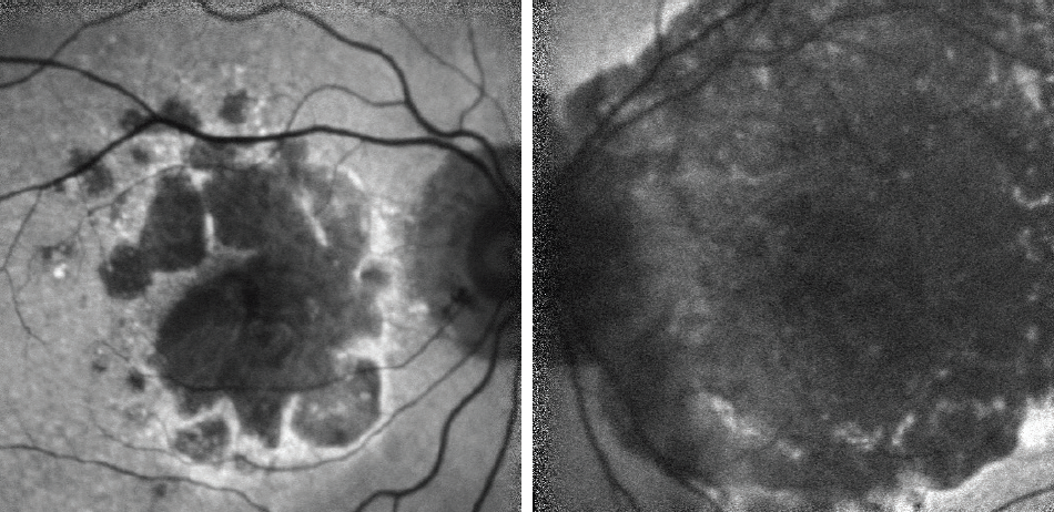 Geographic Atrophy: Options in Clinical Therapy - Retina Today