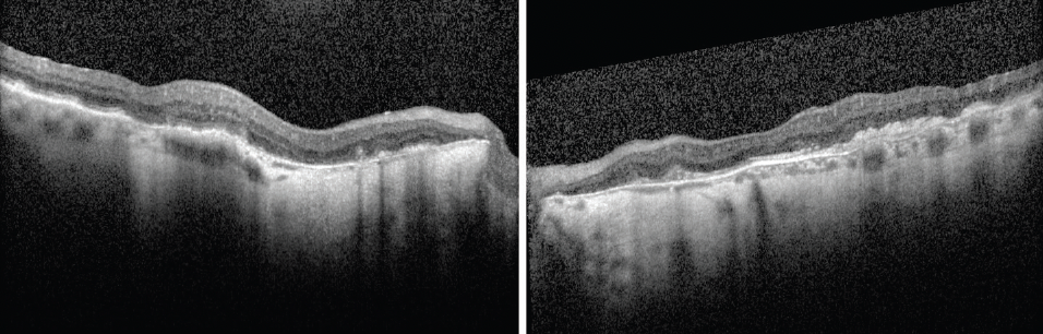 Geographic Atrophy: Options in Clinical Therapy - Retina Today