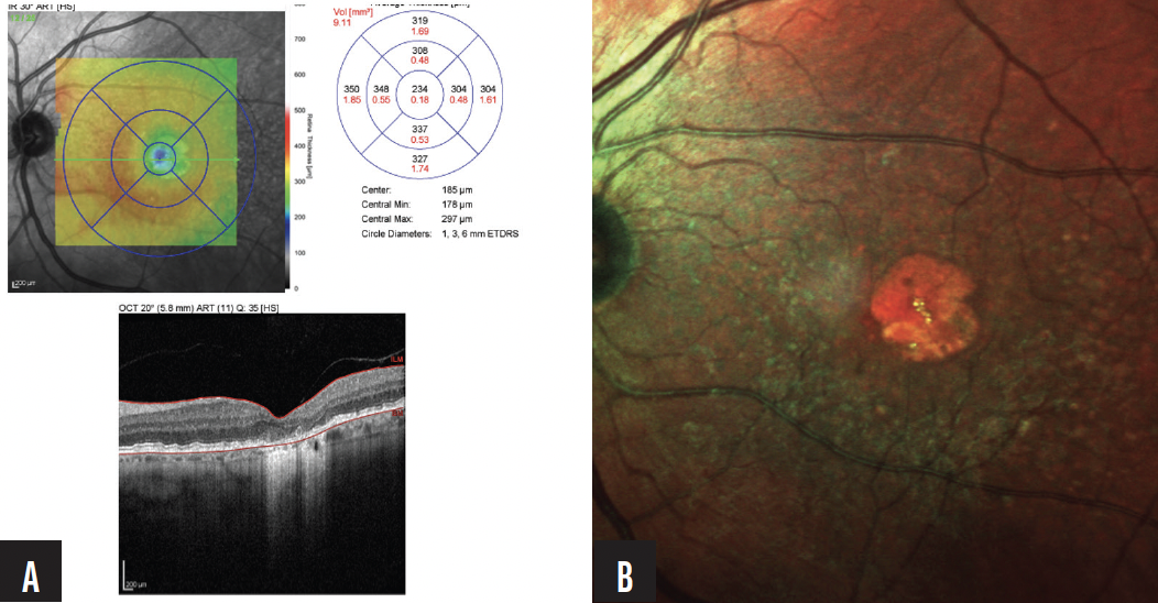 Geographic Atrophy: Options in Clinical Therapy - Retina Today