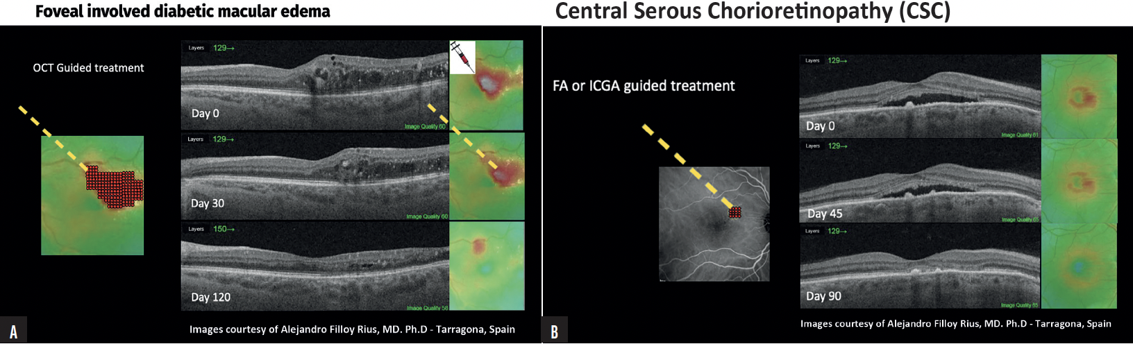 Why You Should Be Using a Subthreshold Laser - Retina Today