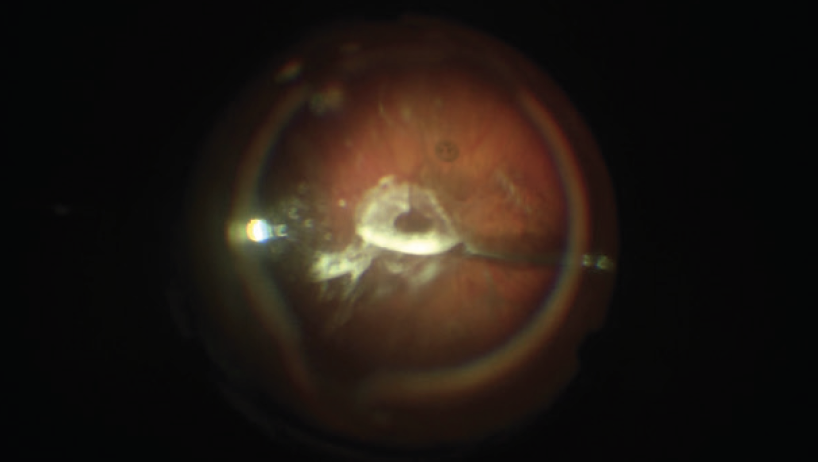 Vitreous Opacities - Retina Today