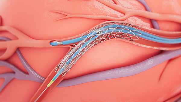 Medtronic’s Onyx Frontier and Resolute Onyx DESs Receive Approval for Bifurcation Indication ...