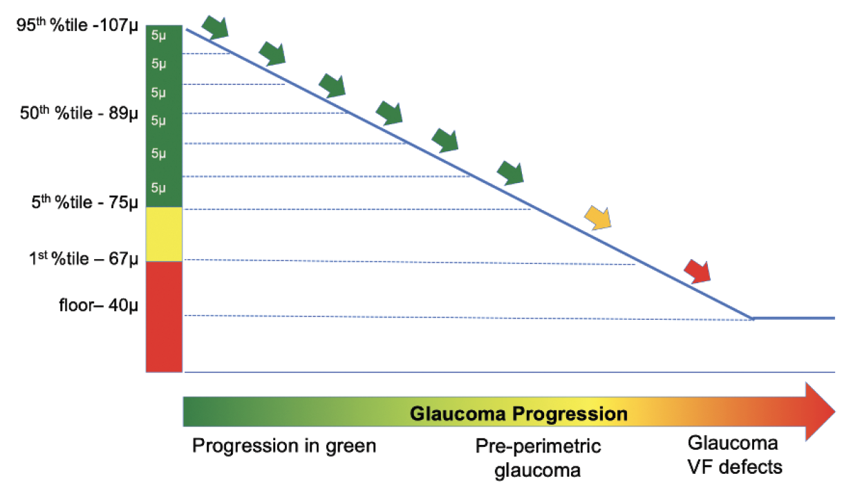 Interventional Glaucoma and Imaging for the Management of Early Disease ...