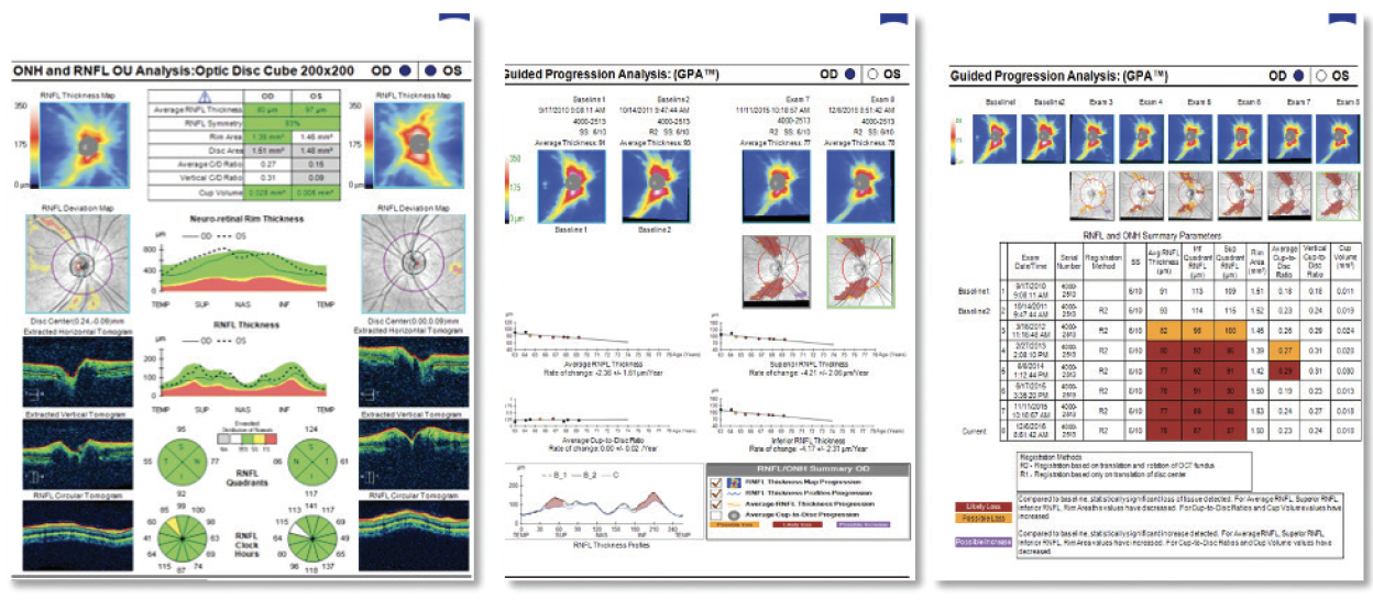 Interventional Glaucoma and Imaging for the Management of Early Disease ...