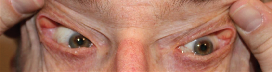 A Guide to Managing Blepharitis - Modern Optometry