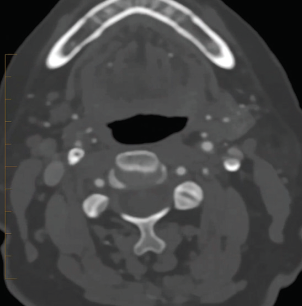 Management of Carotid Stent Restenosis Whether It Be From Previous ...