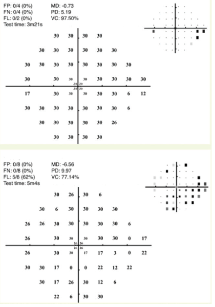 A New Era in Visual Field Testing - Glaucoma Today
