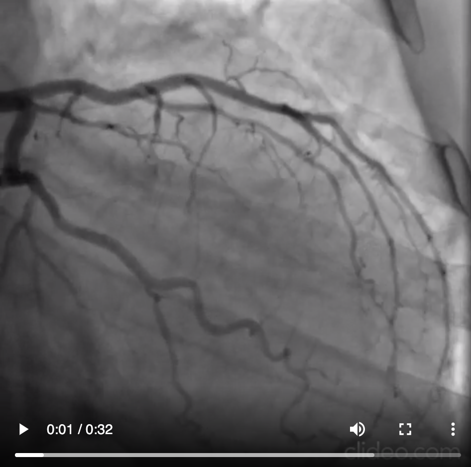 Using Coils to Treat a Coronary Perforation - Cardiac Interventions Today