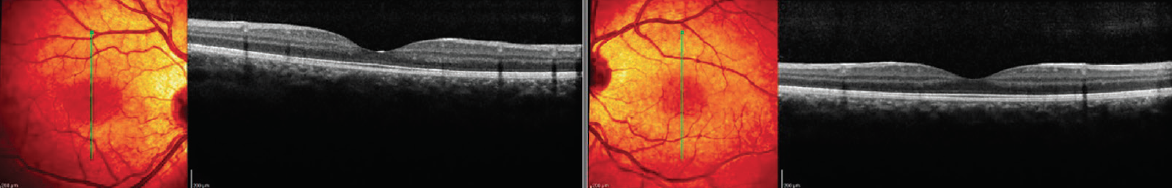 Long-Term Inflammation Control Benefits All Types of Uveitis - Retina Today