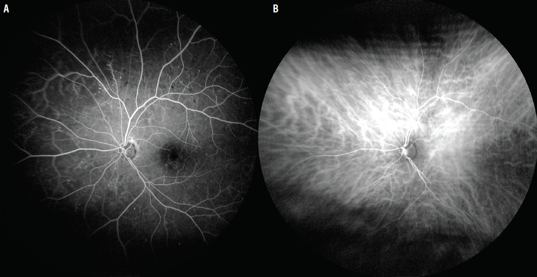 A Masquerader of Circumscribed Choroidal Hemangioma - Retina Today
