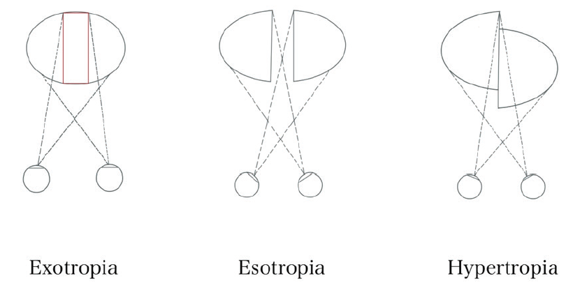 Ophthalmic Presentations of Pituitary Adenoma - Retina Today
