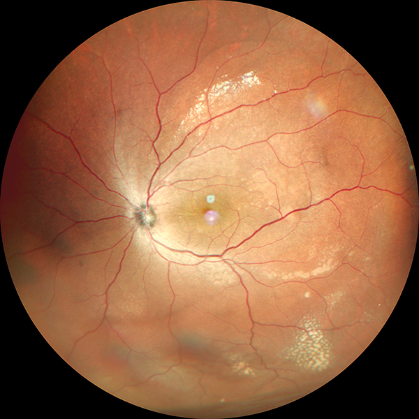 Choroidal Mass: Wading Through the Differentials - Retina Today