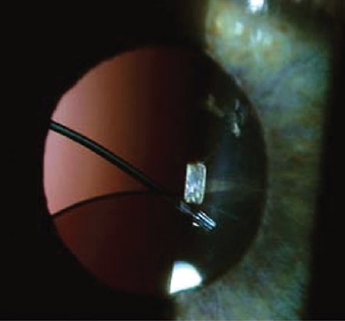 Tips for Repositioning Three-Piece IOLs - Retina Today