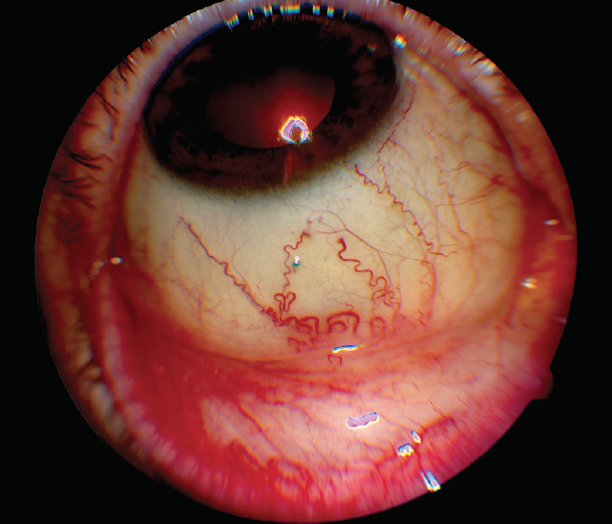 Tips for Repositioning Three-Piece IOLs - Retina Today