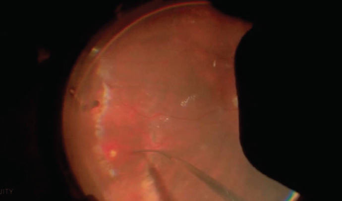 Digitally Assisted Surgery For Retinal Detachment With Giant Retinal ...