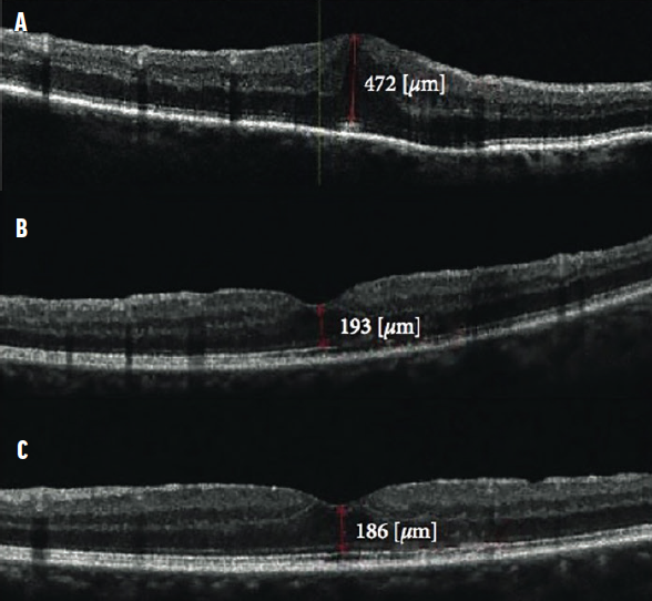 Limited or Complete Vitrectomy for ERM? - Retina Today