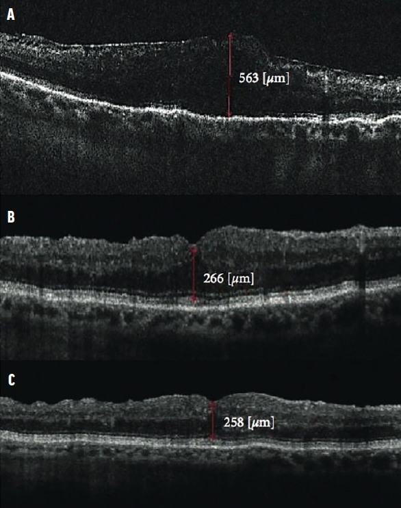 Limited or Complete Vitrectomy for ERM? - Retina Today