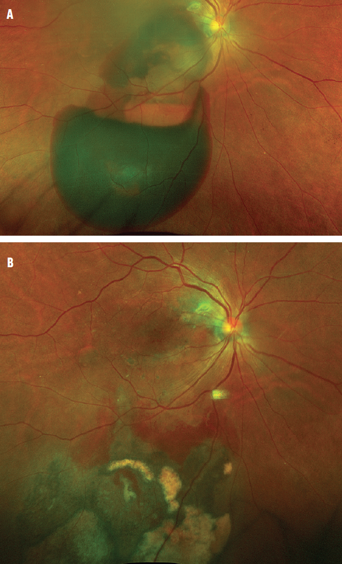 Better Surgeon Control for Submacular Hemorrhage Injection - Retina Today