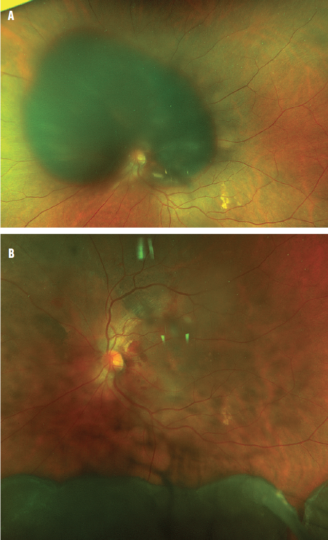 Better Surgeon Control for Submacular Hemorrhage Injection - Retina Today