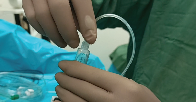 Better Surgeon Control for Submacular Hemorrhage Injection - Retina Today