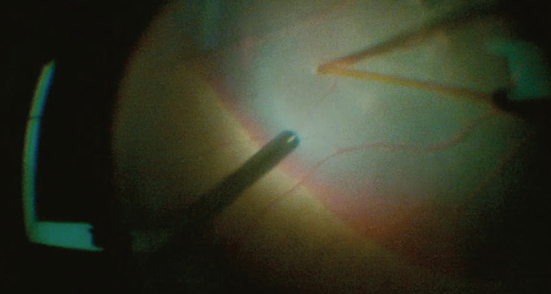 Better Surgeon Control for Submacular Hemorrhage Injection - Retina Today