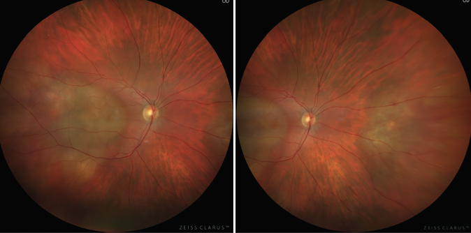 Metastases of Surprising Origin - Retina Today