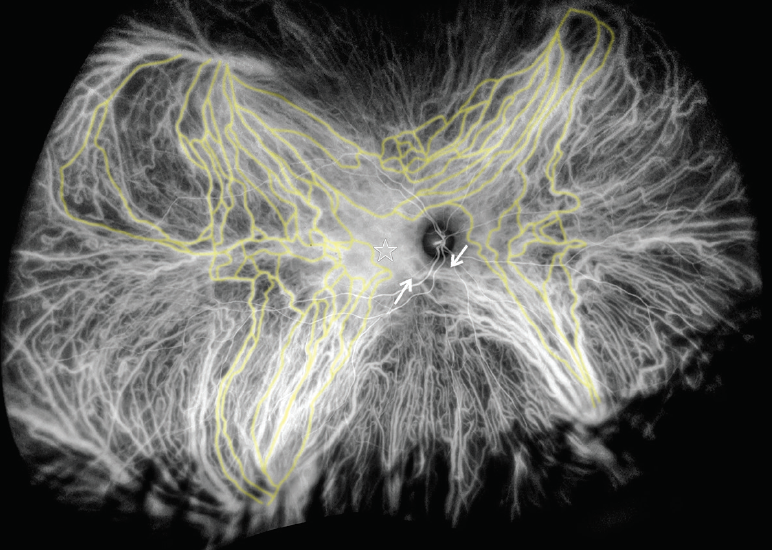 Moving Beyond Pachychoroid - Retina Today
