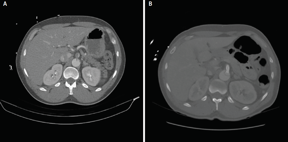 Diagnosis and Management of Acute Mesenteric Ischemia - Endovascular Today