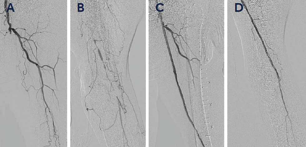 Directional Atherectomy and Drug-Coated Balloon Therapy for Leaving ...
