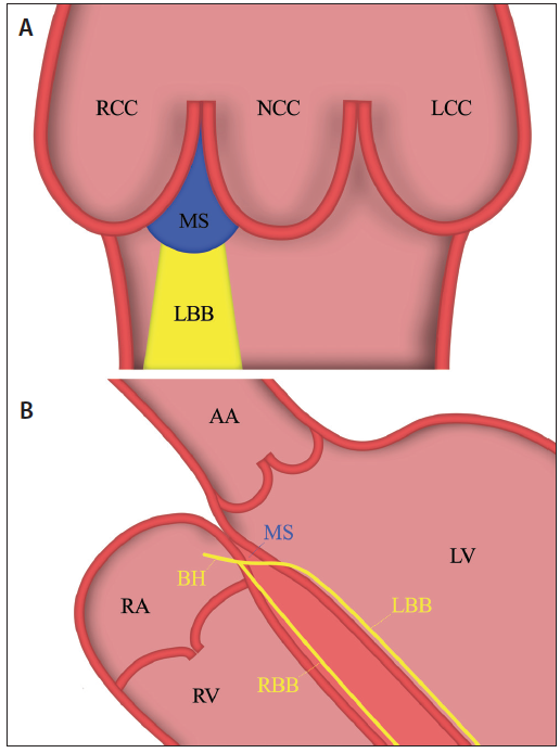 Cusp Overlap Technique in TAVR - Cardiac Interventions Today