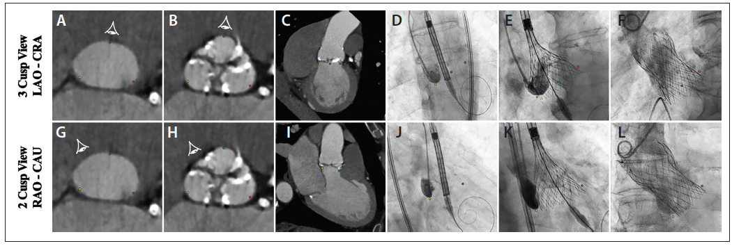 Cusp Overlap Technique in TAVR - Cardiac Interventions Today