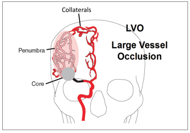 Baseline Stroke Core and Time From Onset Metrics: How the Landscape Is ...