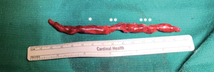 The Right Device in Right Heart: AngioVac System for Clot in Transit ...