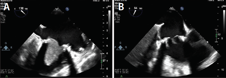 The Right Device in Right Heart: AngioVac System for Clot in Transit ...