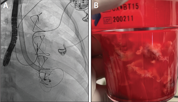 The Right Device in Right Heart: AngioVac System for Clot in Transit ...