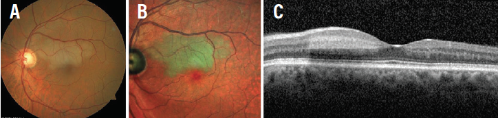 The Benefits of Identifying Paracentral Acute Middle Maculopathy ...
