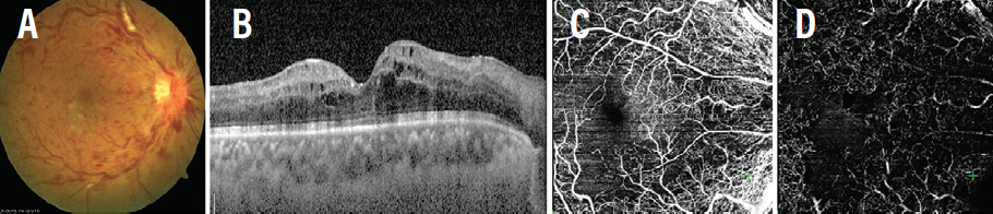The Benefits of Identifying Paracentral Acute Middle Maculopathy ...