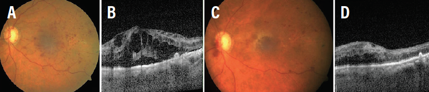 The Benefits of Identifying Paracentral Acute Middle Maculopathy ...