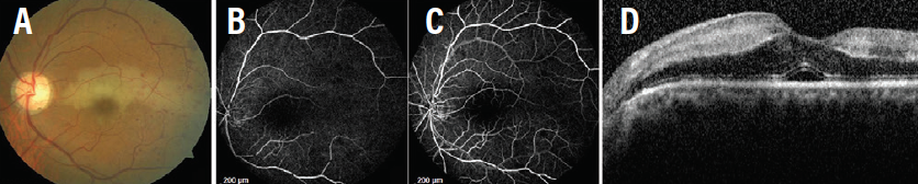 The Benefits of Identifying Paracentral Acute Middle Maculopathy ...