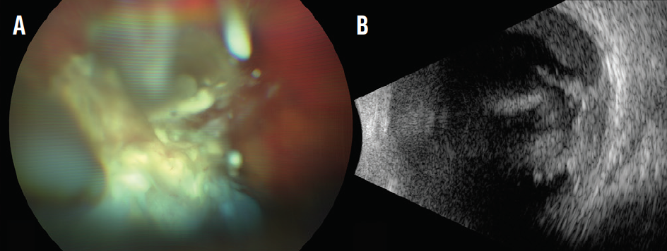 Transradial IntraArterial Chemotherapy for Retinoblastoma - Retina Today